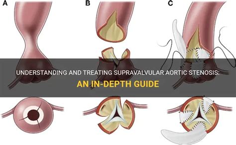 Understanding And Treating Supravalvular Aortic Stenosis An In Depth
