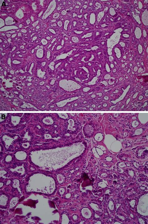 Mixed Adenosiscolumnar Lesion A Low Magnification ×100 View Shows A
