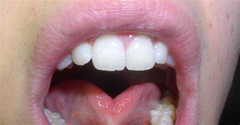 【衛教】舌繫帶tongue Tieankyloglossia