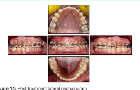 Figure 14 From Modified Twin Block For A Class Ii Division 1 Hypodontia Case Semantic Scholar
