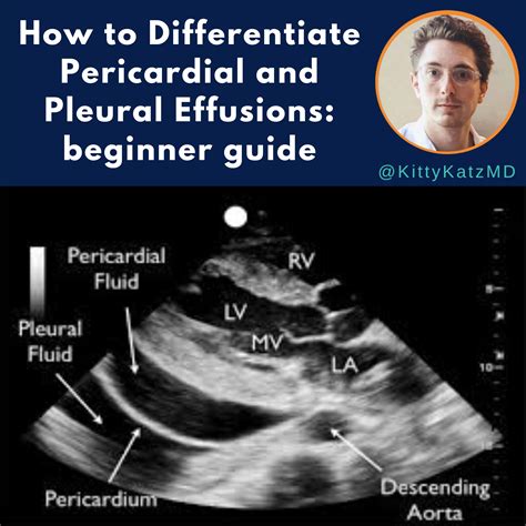 Mild Pericardial And Bilateral Pleural Effusion Downl