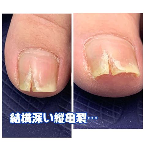 爪が縦に割れる縦亀裂足爪トラブルは爪ケア専門店へご相談ください サロン運営への思いやネイルのお手入れについて綴るブログ 宜野湾市の