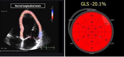 Limitations Of Gls Echo Dr S Venkatesan Md