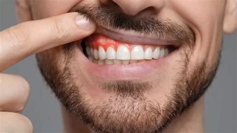 A Comprehensive Periodontal Guide Understanding Gingivitis Vs