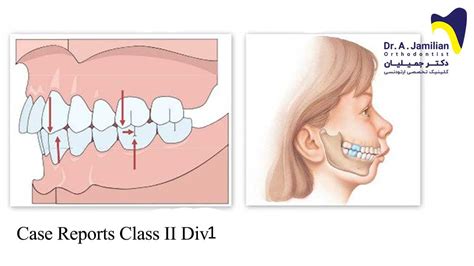 Class Ii Division 1 Dr Jamilian