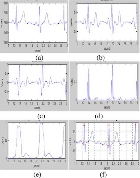 Figure 3 From Comparative Analysis Of Qrs Detection Algorithms And