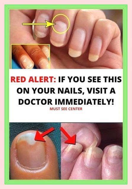 7 Common Nail Conditions Linked To Serious Diseases That You Shouldnt