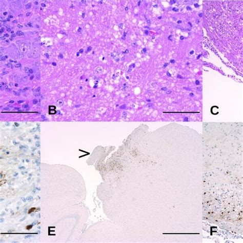Herpes Simplex Virus 2 Hsv 2 Replicates Principally Within The
