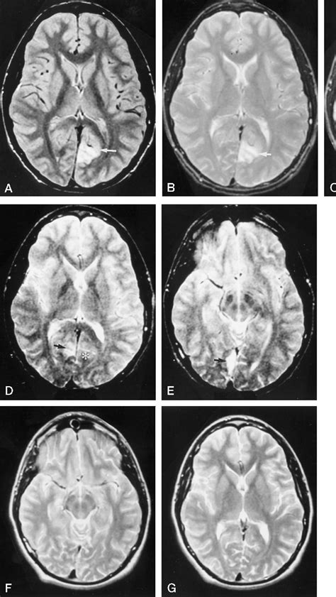 Migraine And Mri Abnormalities