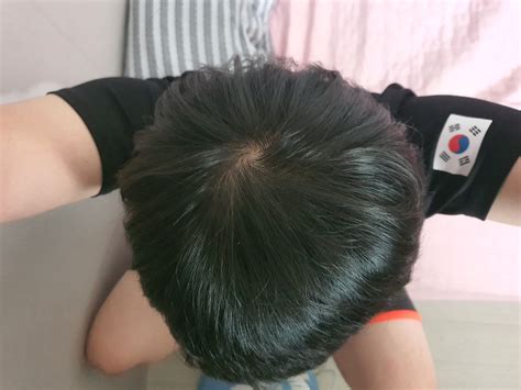 이거 정수리 탈모인가요 궁금합니다 궁금할 땐 아하