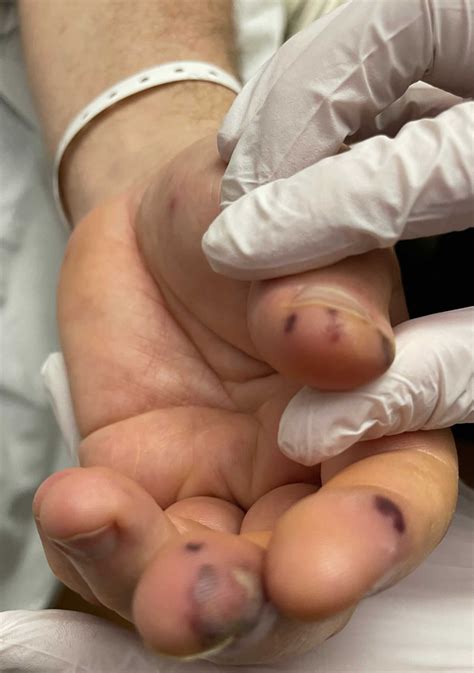 Osler Nodes Janeway Lesions And Splinter Hemorrhages