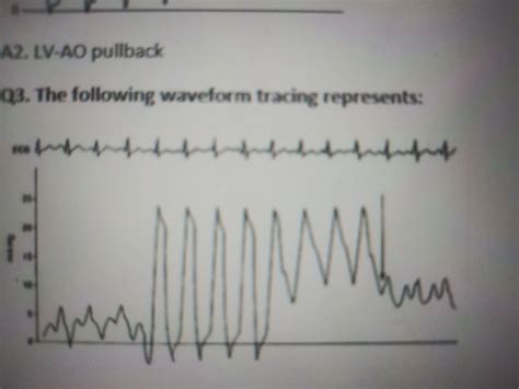 Waveform Pathology Flashcards Quizlet