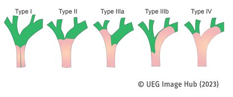 Ueg Image Hub Ueg United European Gastroenterology Ueg Image Hub Ueg United European Gastroenterology