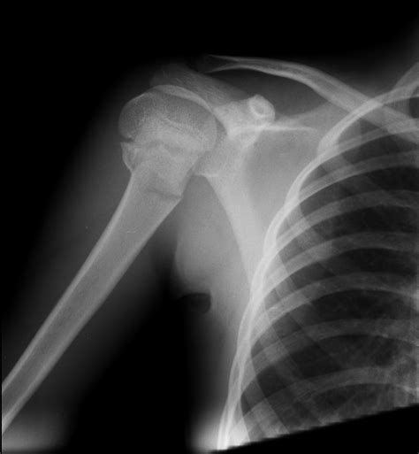 Fracture Fridays Why Do They Call It The Surgical Neck” Of The