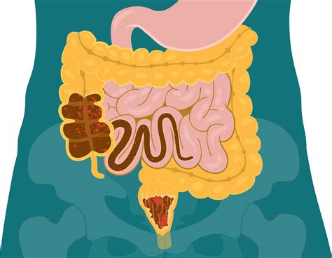 Hl Ulcerative Colitis Progress Guide Ulcerative Colitis Progression Guide