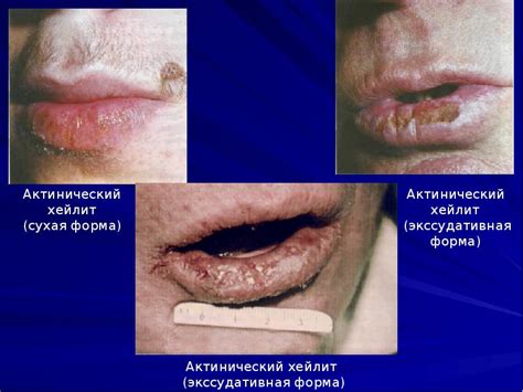 Хейлиты