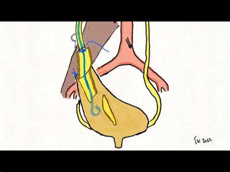 Boari Flap And Psoas Hitch For Treatment Of Long Ureteral Stenosis