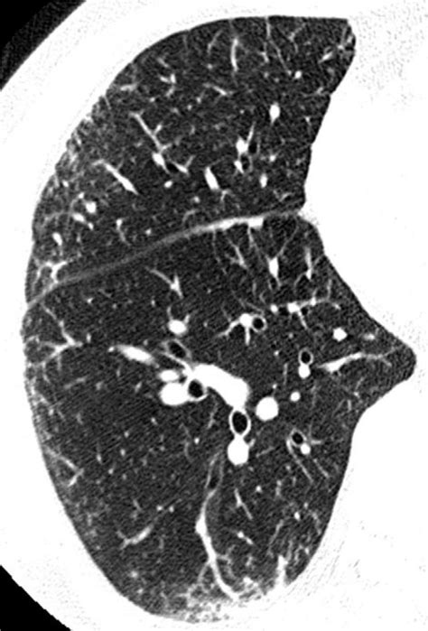 High Resolution Computed Tomography Showed Bilateral Ground Glass
