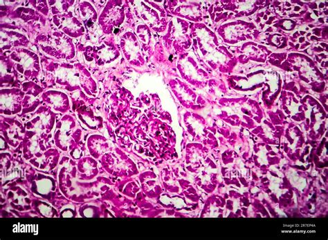 Glomerulonephritis Light Micrograph Of Tissue From A Kidney In A Case