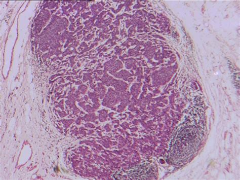 Adjacent Thoracic Lymph Node Metastases Originating From Two Separate