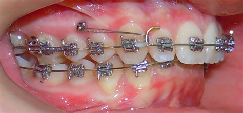 Beach Braces Beaches Orthodontist Toronto Orthodontist Invisalign