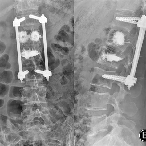 Preoperative And Postoperative X‐ray Of The Illustrative Case A A Download Scientific