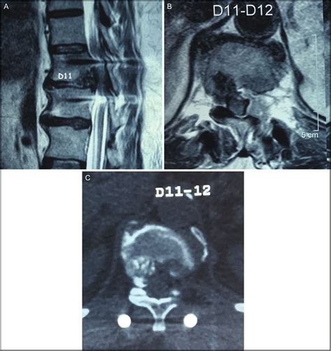 A Postoperative T2 Weighted Sagittal Mri B Postoperative