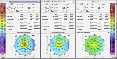 Axial Sagittal Curvature Maps Showing Additional Steepening Of The Download Scientific Diagram