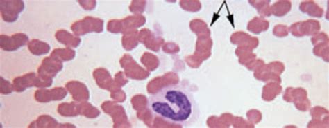 Clin Path Erythrocyte Morphology And Abnormalities 2 Flashcards Quizlet