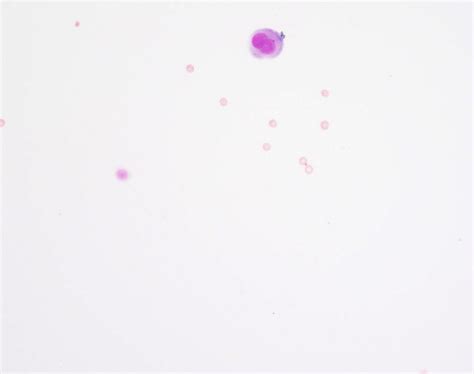 Pathology Outlines International System For Reporting Serous Fluid Cytopathology
