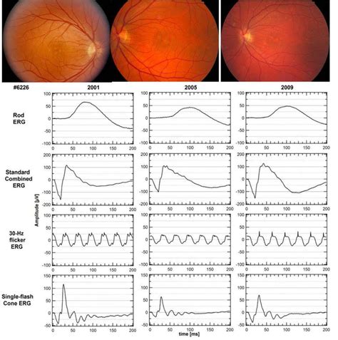 Pattern Dystrophy In A Female Aged 36 Years Fam8 6226 Milder Vision