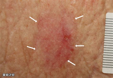 Basal Cell Carcinoma Skin Cancer 909