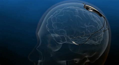Keck Medicine Physicians First To Implant Epilepsy Controlling Device
