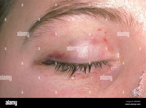 Itchy Rash On Eyelids At Ashley Wu Blog