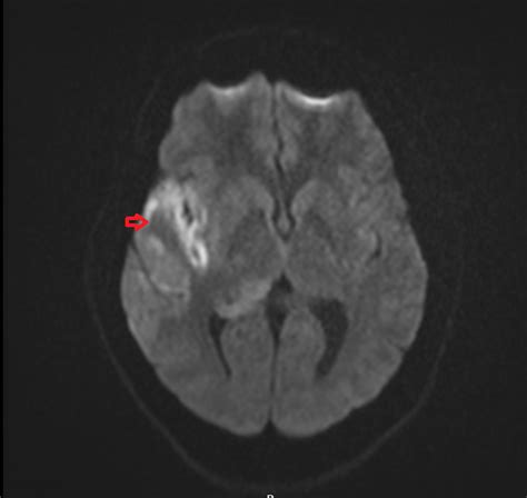 Mri Encephalitis Radiology Article On Herpes Simplex Encephalitis