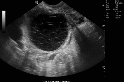 Ovarian Cyst Ultrasound