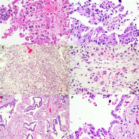 High‐grade Features Of Idh1 2 Mutated Lung Adenocarcinomas Hematoxylin Download Scientific