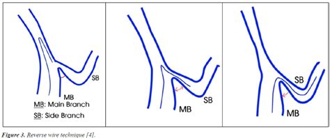 The Ï shaped reverse guidewire technique for extremely angulated bifurcation of severe left