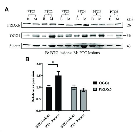 Protein Expression Analysis Of Ogg1 And Prdx6 In The Btg And Ptc