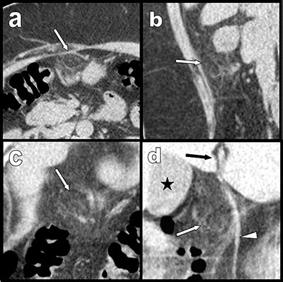 Falciform Ligament Ultrasound