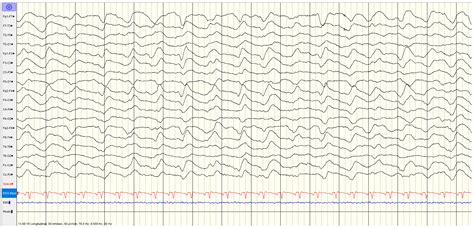 Electroencephalography Eeg For Neurological Prognostication In Post