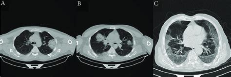 axial computerized tomography of lungs in 2019 ncov infected cases a
