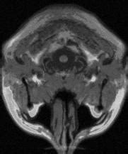 GitHub Sraycju BrainTumorSegmentation Brain Tumor Segmentation Using CNN