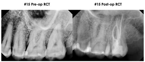15 Rct Vertucci Type 2 Buccal Canals Anil Gudipati