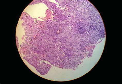 Firm Nodular Swelling Over The Scalp Figure 2 Squamous Cell Carcinoma