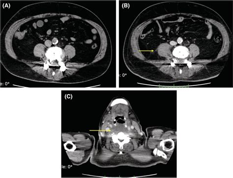 Ct Scan Without Contrast‐enhancement On The Admission A Ct Scan With
