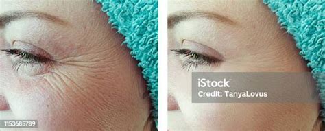 여자 얼굴 주름 전후 치료 콜라주 가방에 대한 스톡 사진 및 기타 이미지 가방 개념 개념과 주제 Istock