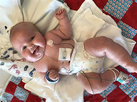 Rare Birth Defect Syndromes