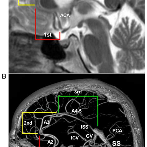 P1 Hypoplasia The Arrow And Dotted Circle Show The Hypoplastic P1