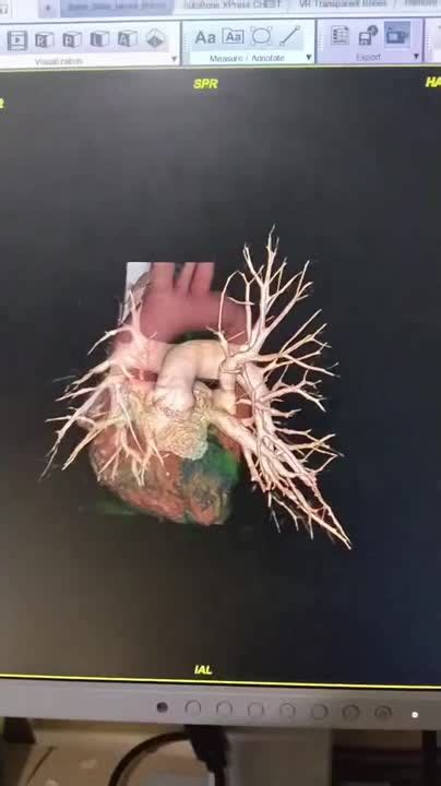 Video Atharv Mishra On Linkedin Cta Pulmonary Angiography